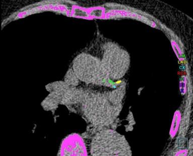 Le coroscanner, au plus près de la plaque | Le Quotidien du Médecin ...