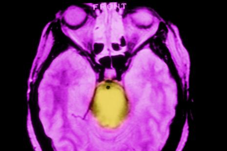 Voranigo, première thérapie ciblée dans le gliome, autorisée en Europe ...