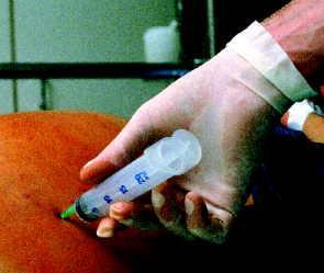 Ponction d'ascite : à quels patients faut-il la faire et comment la ...